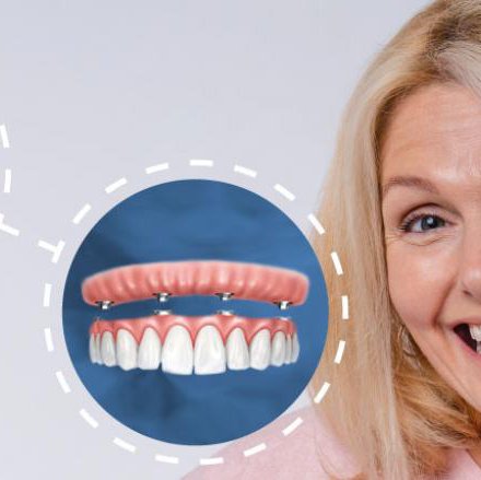 Mastering All-on-Four Implants: A Comprehensive Guide to Pre-Procedure ...