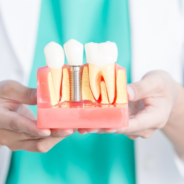 Discover 5 Ways the Dental Implants Could Change Your Life