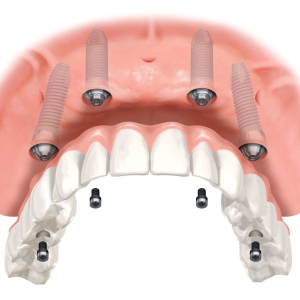 All-on-4 Dental Implants Procedure | Step-by-Step Guide