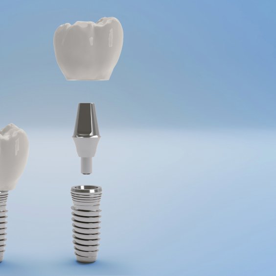 How to Choose the Right Tooth Replacement Option: A Complete Guide
